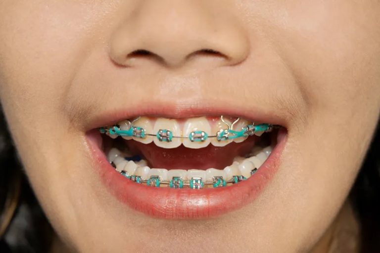 Elastics for Braces - Everything You Need to Know - Smile Country ...